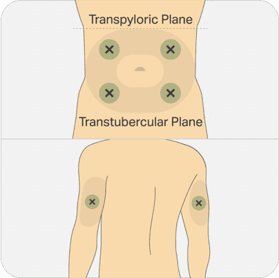 Depot Delivery & Administration | PERSERIS® (risperidone) HCP